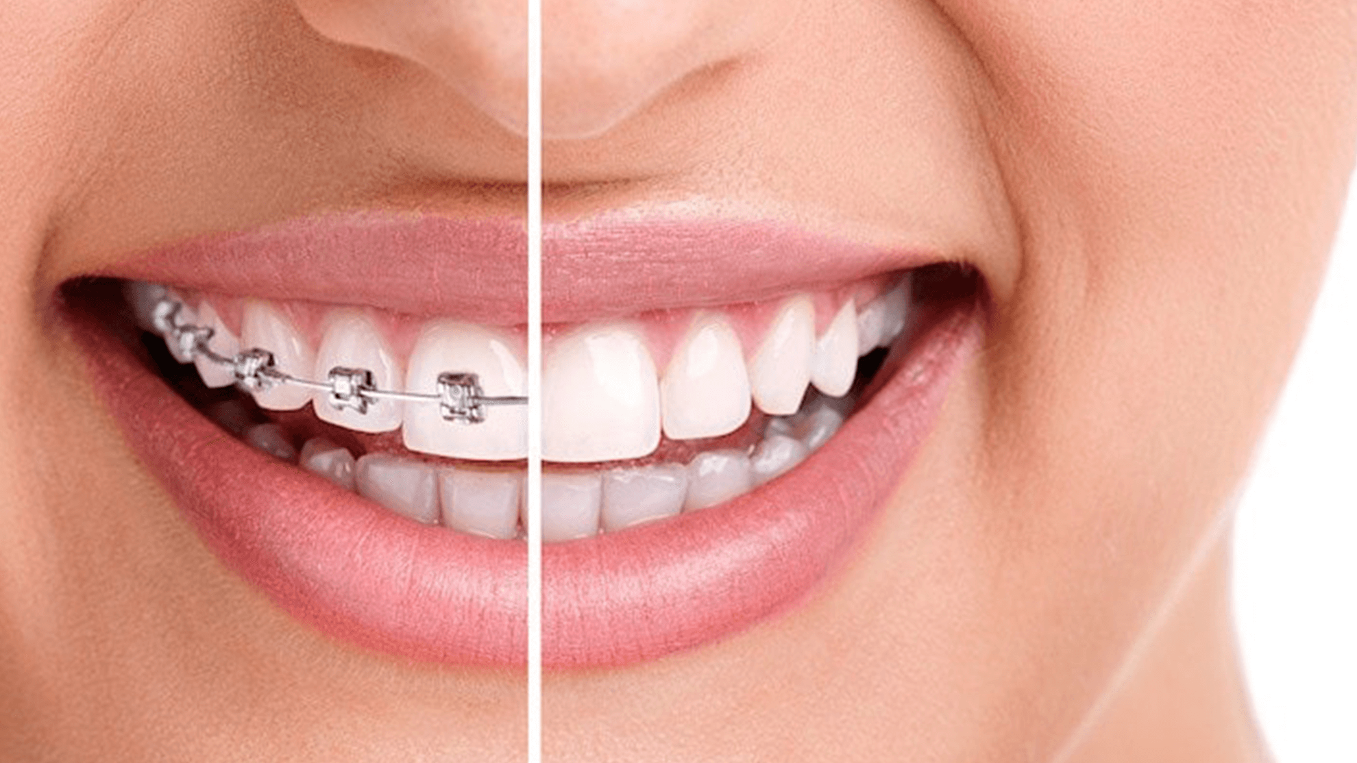 4 Ways You Can Benefit from Invisalign